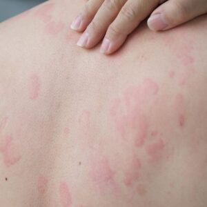 Hives vs. Bug Bites: How to Tell the Difference | Northeast Allergy